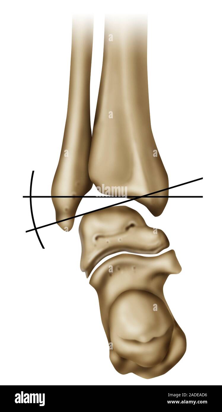 Ankle joint movement, illustration. Bones of the ankle joint, showing ...