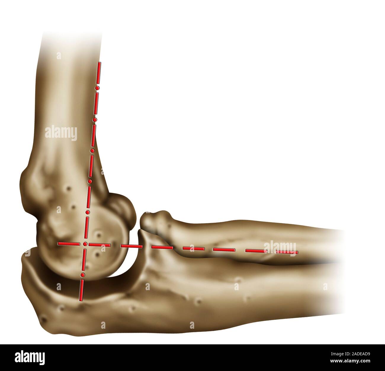 Elbow joint alignment, illustration. Bones of the elbow joint, showing ...