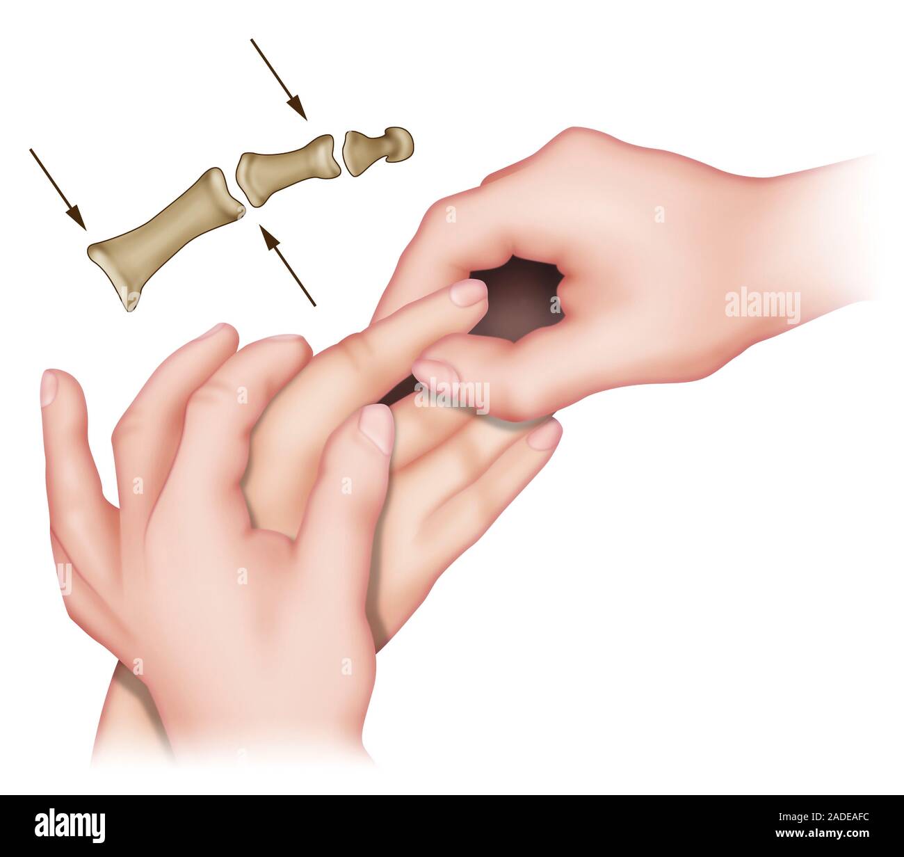 Hypermobile finger joints, illustration. This condition is also known ...