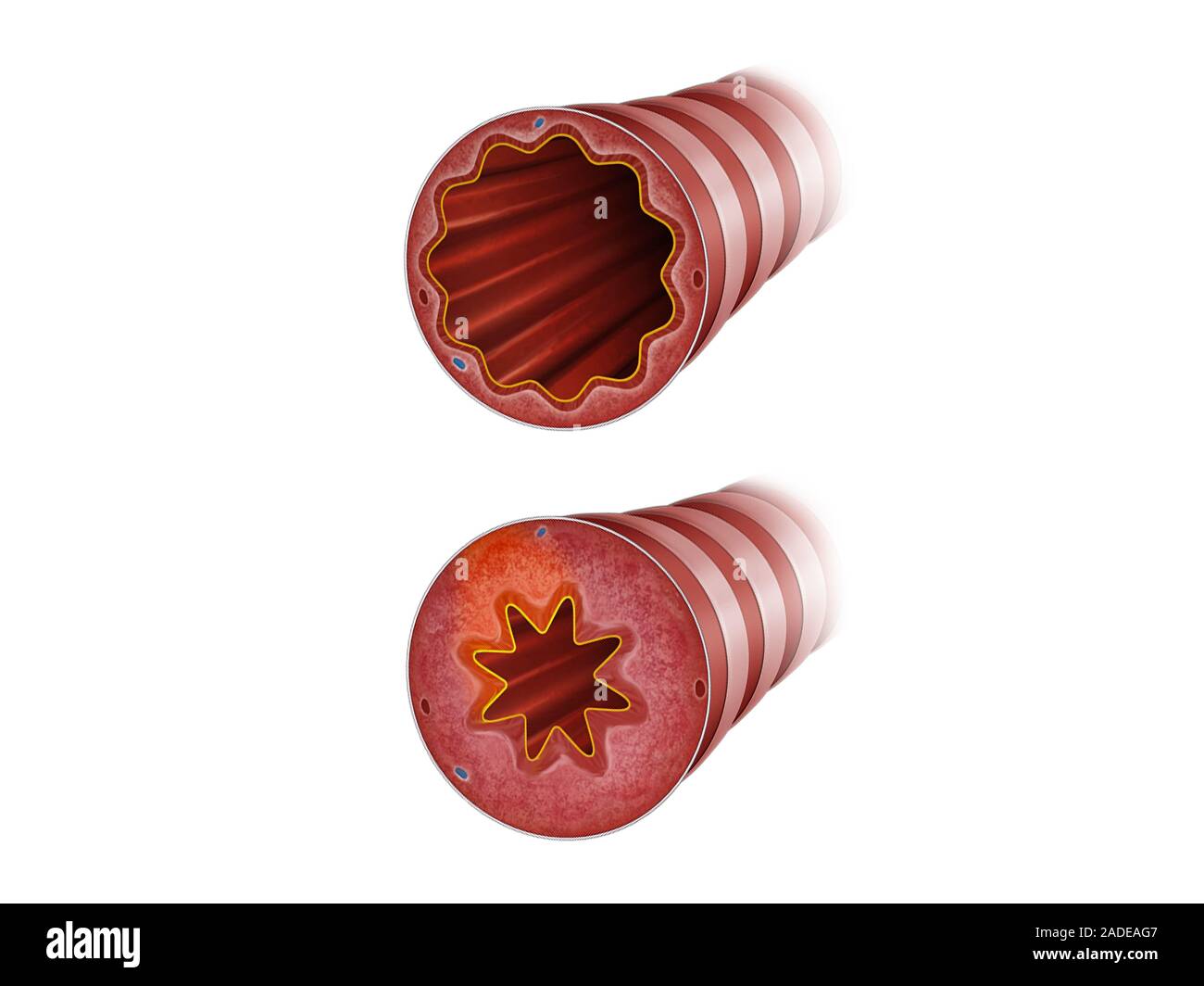 Asthma pathology, comparative illustrations. The artworks show cross ...