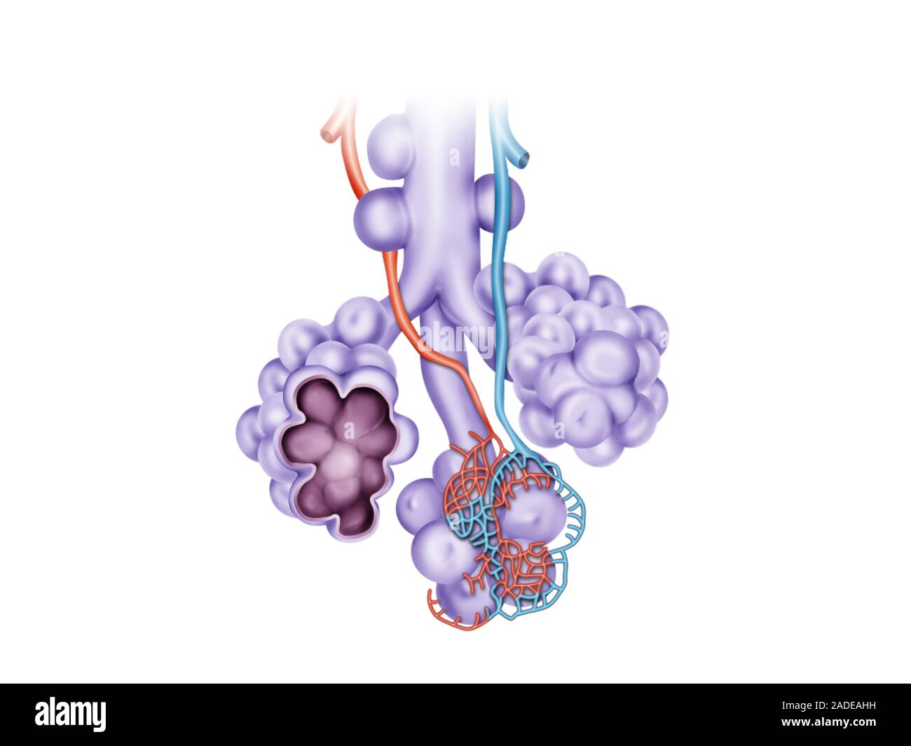 Damaged alveoli in lung disease, illustration. Damaged alveoli with a ...
