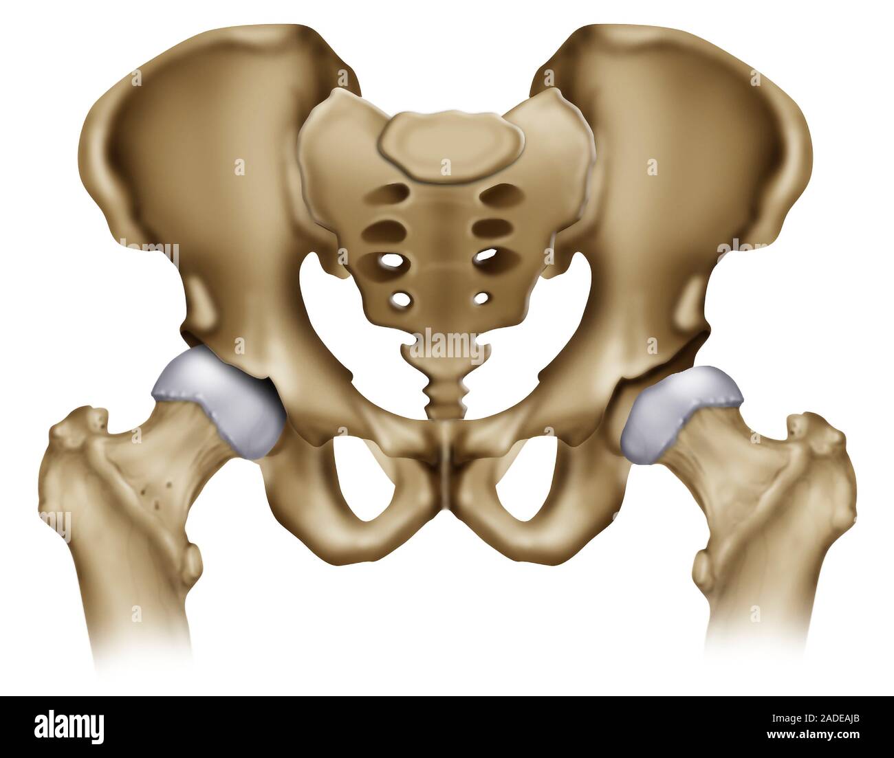 Perthes disease, illustration. The hip at right (the left hip) has been ...