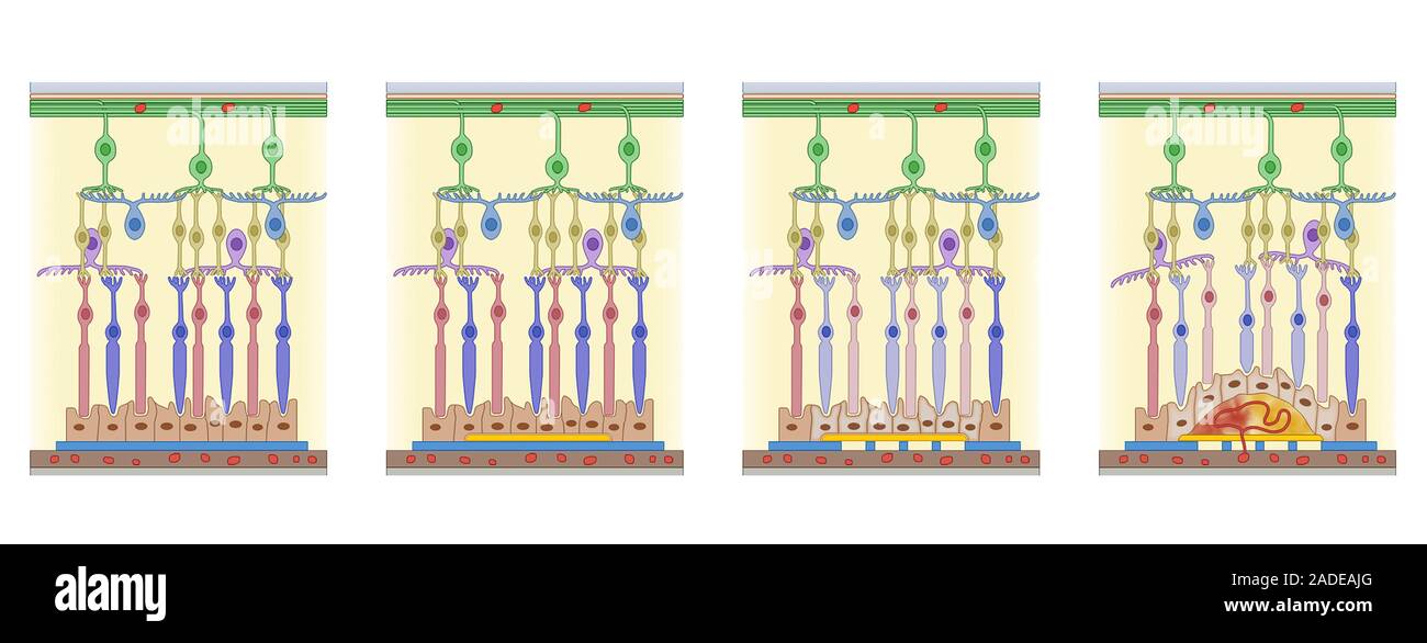 Development of retinal cancer, illustration. Sequence of four images of ...