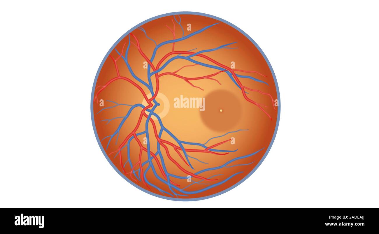 Retinal vascular occlusions, illustration. The retina, the light ...