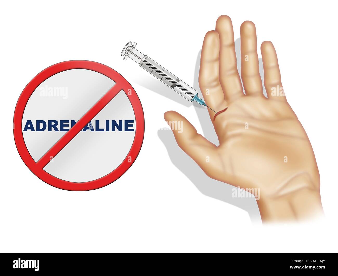 Use of adrenaline in woundcare, illustration. The sign at left ...