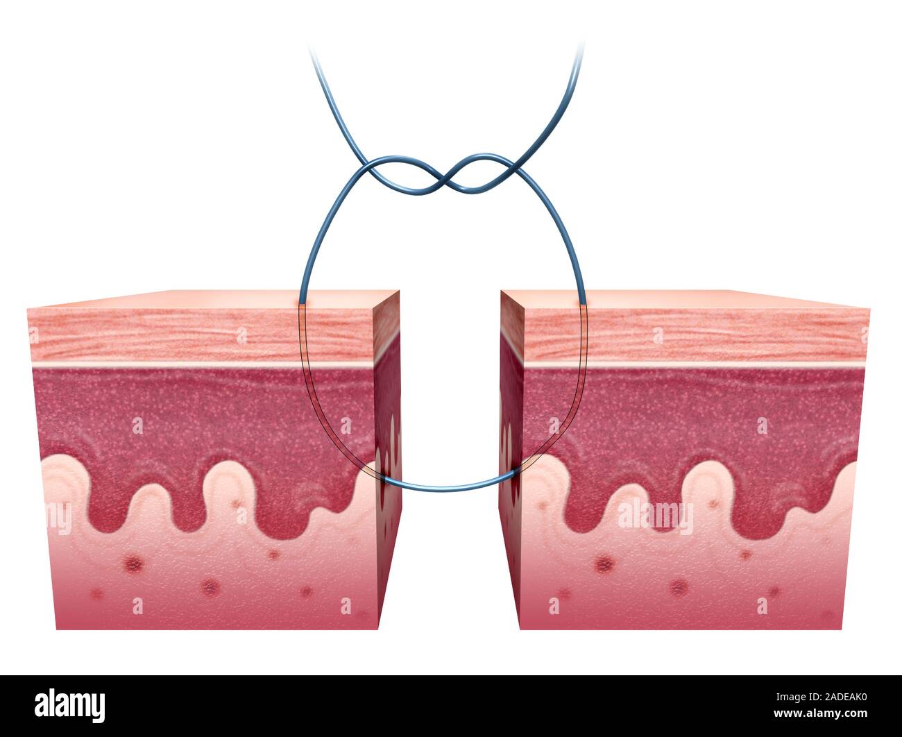 Surgical suturing of skin. Illustration of the depth within the skin ...