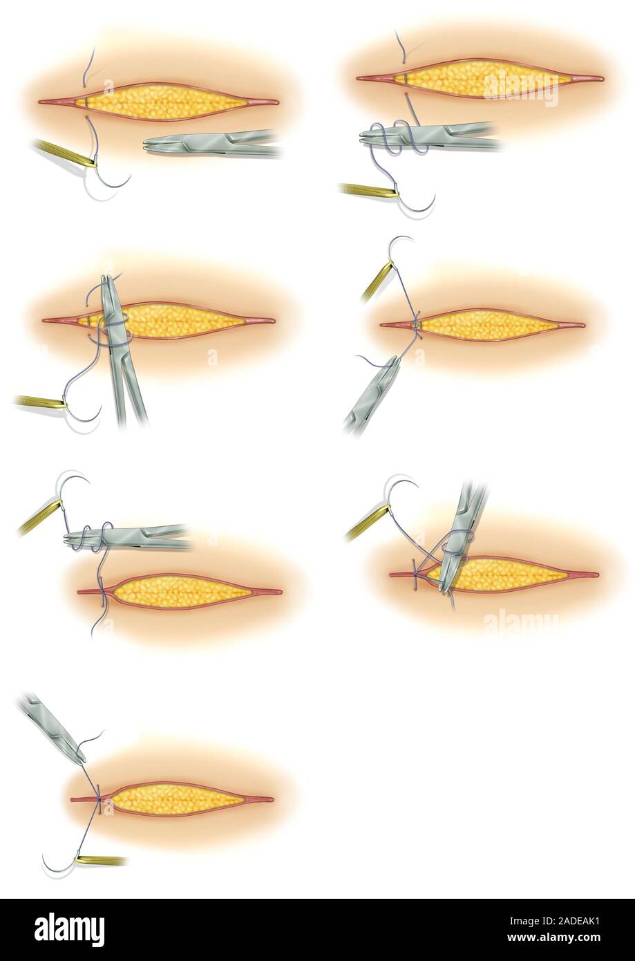 Suturing of surgical incision, illustration. This sequence of seven ...