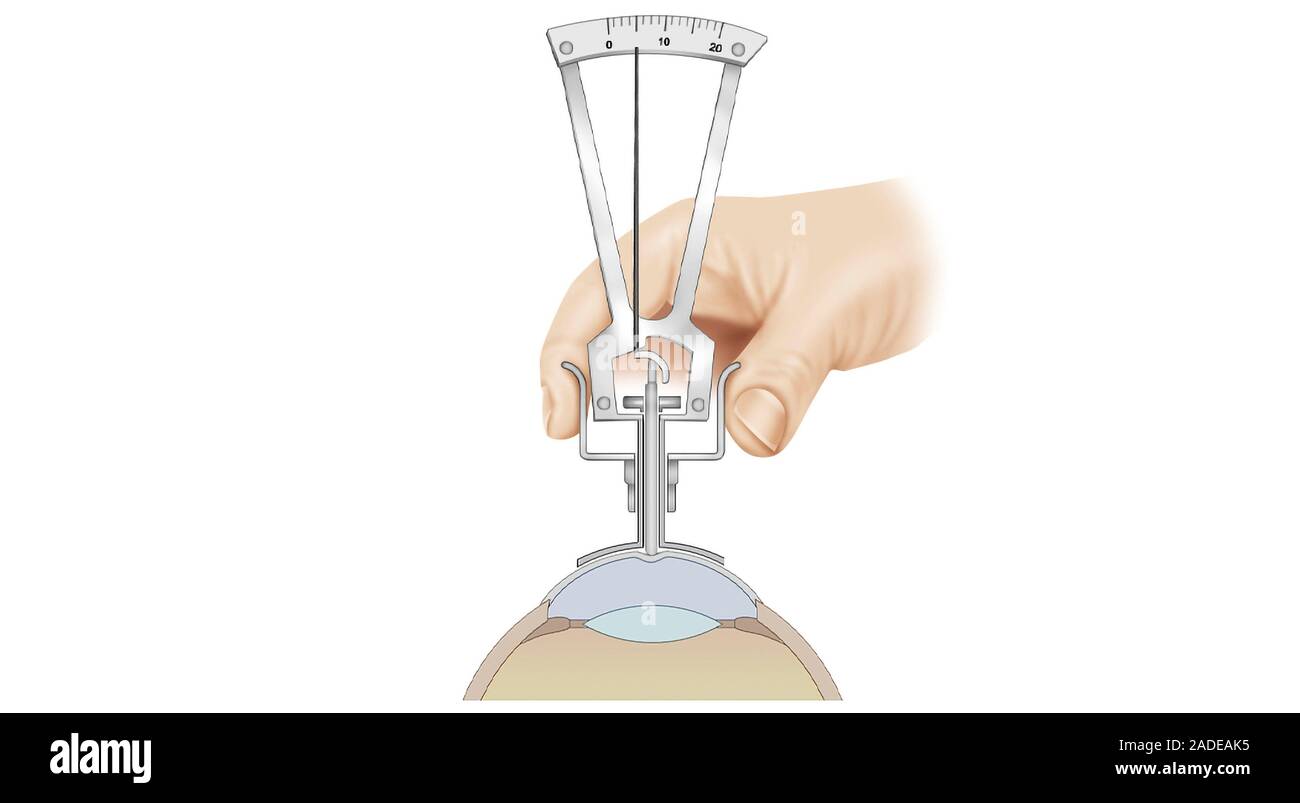 Tonometry, illustration. This technique is used to measure the internal ...