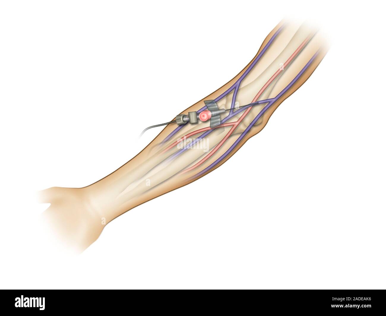 Long line insertion, illustration. Long line catheters are inserted ...