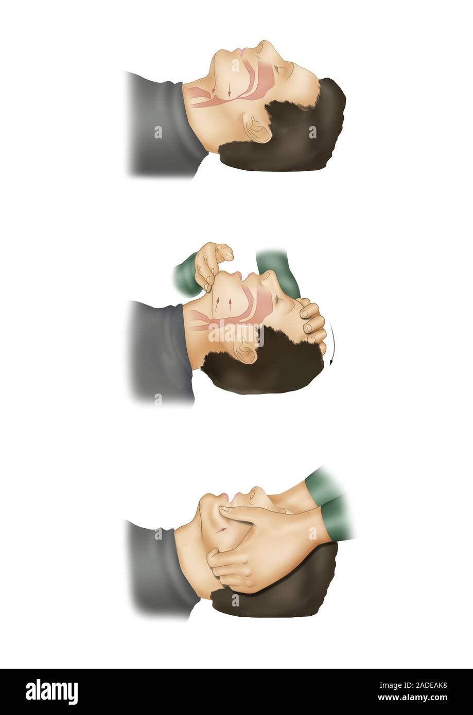 First aid head tilt technique, illustration. This tilting of the head ...
