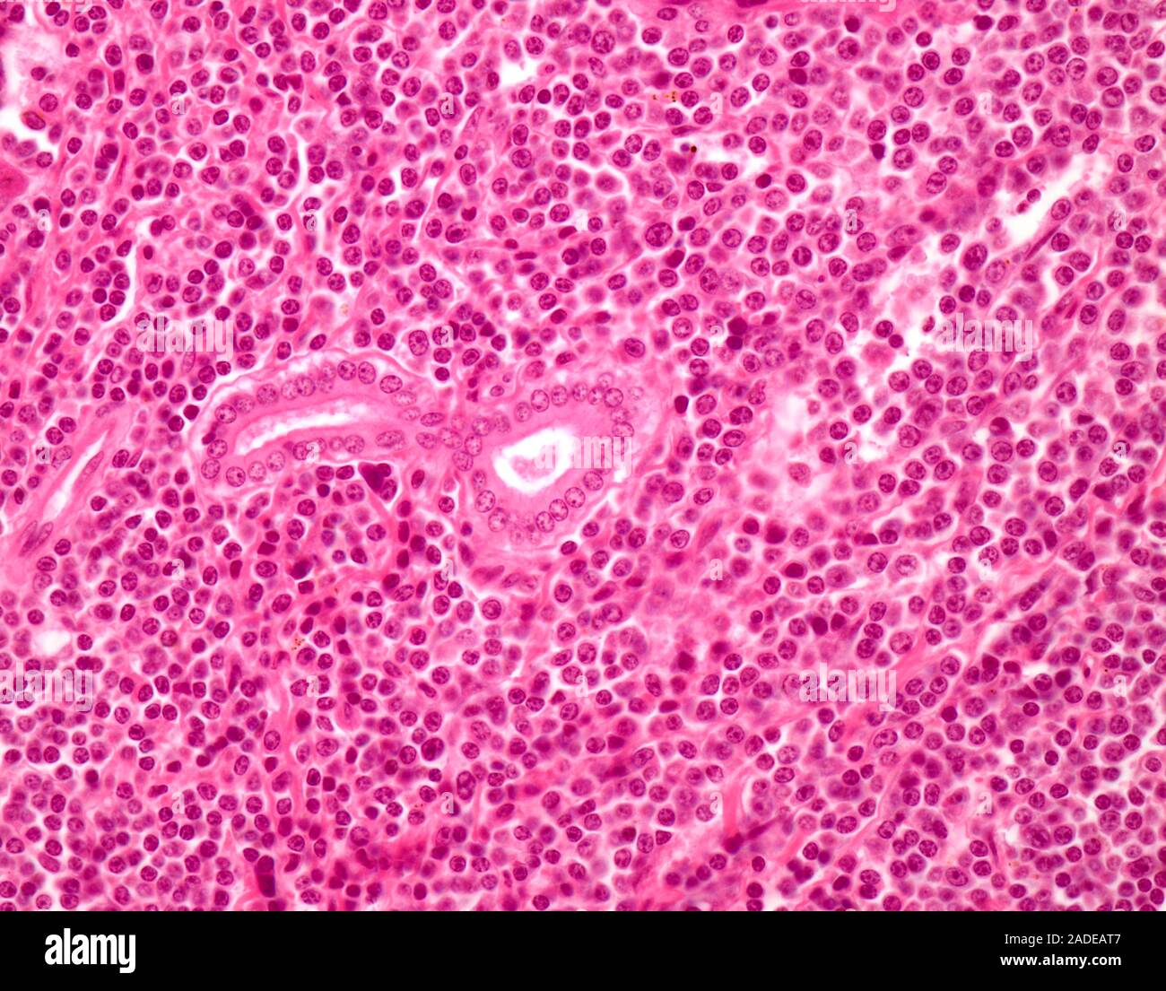 Small lymphocytic lymphoma, light micrograph. B-cell chronic ...
