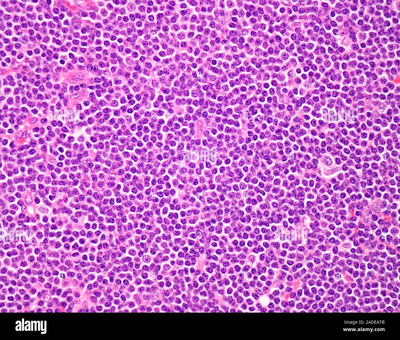 Small lymphocytic lymphoma, light micrograph. B-cell chronic lymphocytic leukemia and small ...