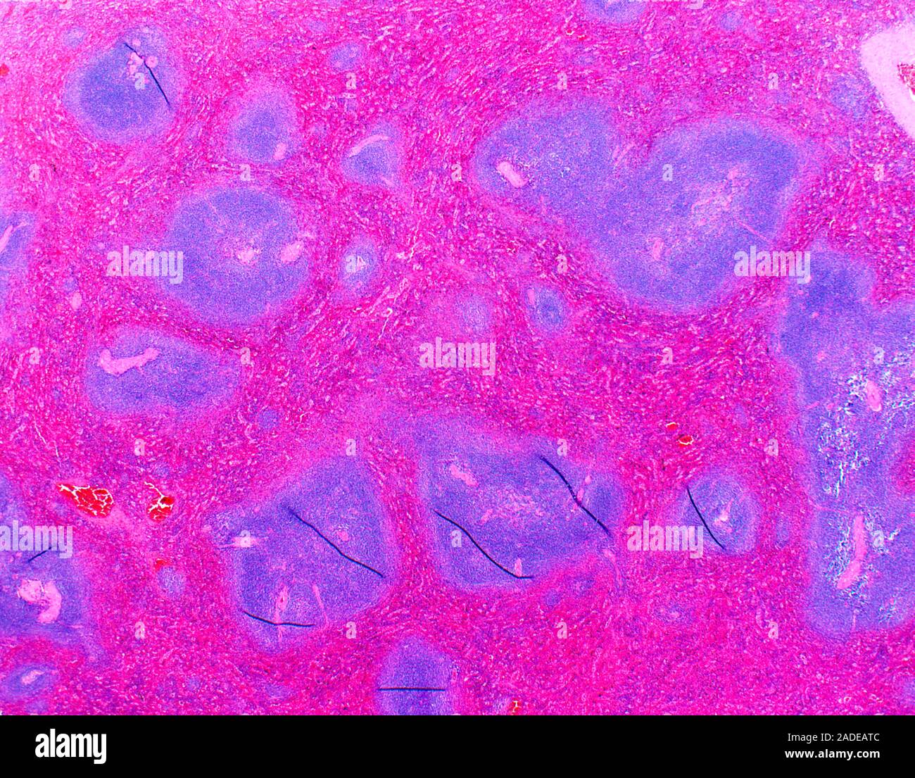 Small lymphocytic lymphoma, light micrograph. B-cell chronic ...