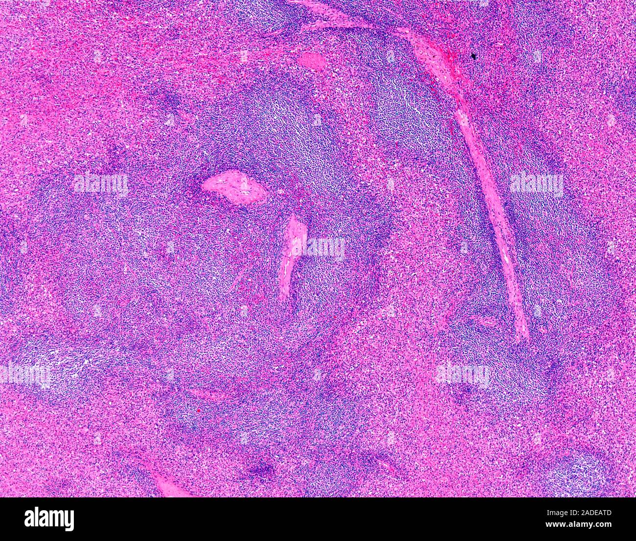 Small lymphocytic lymphoma, light micrograph. B-cell chronic ...