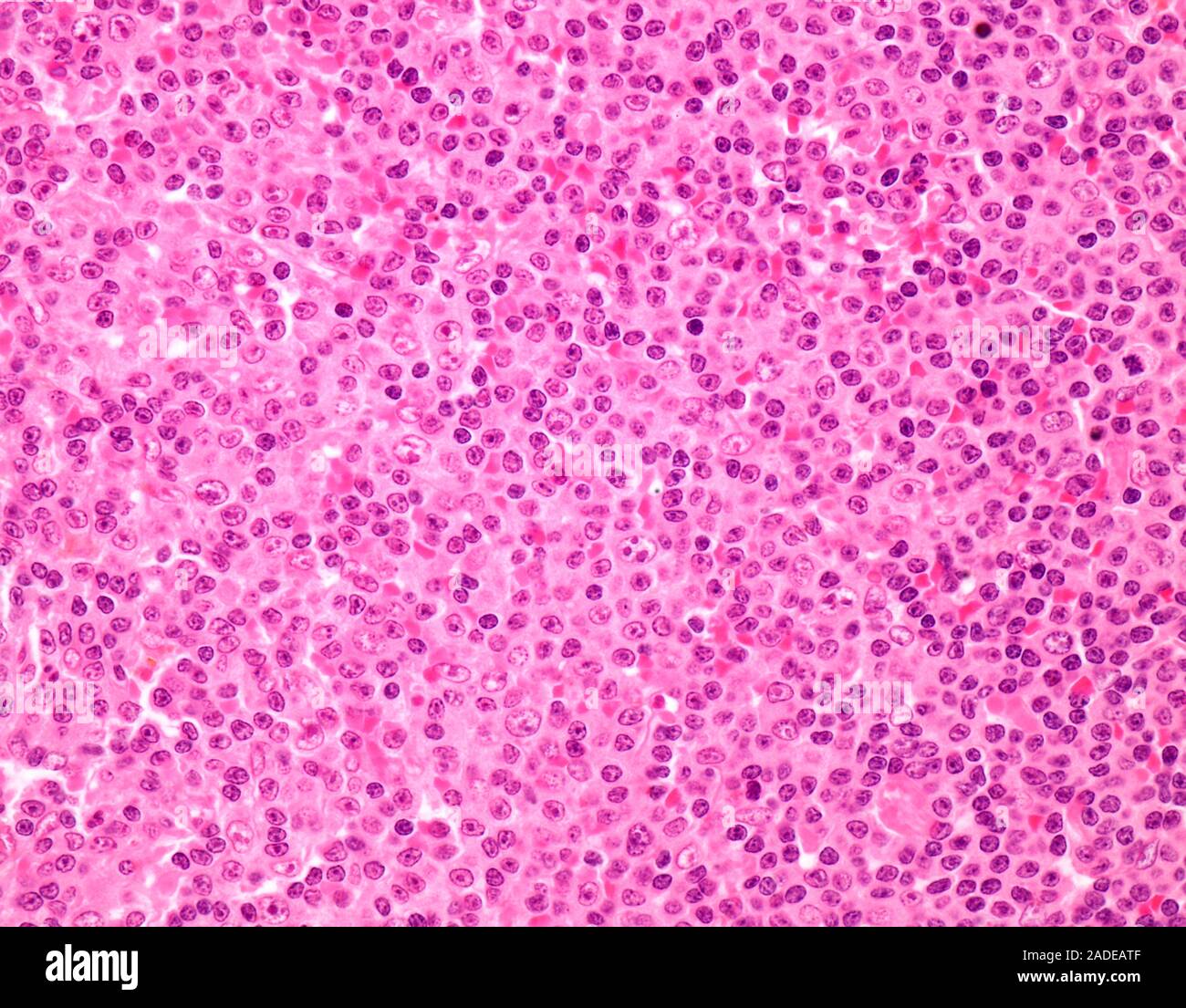 Small Lymphocytic Lymphoma Light Micrograph B Cell Chronic