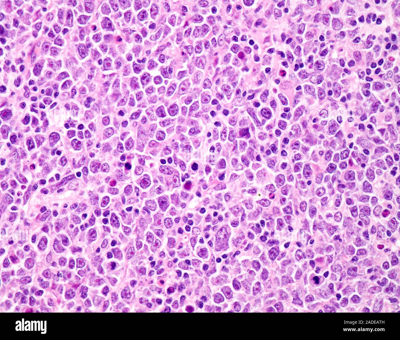 Diffuse large B-cell lymphoma, light micrograph. Diffuse large B-cell ...