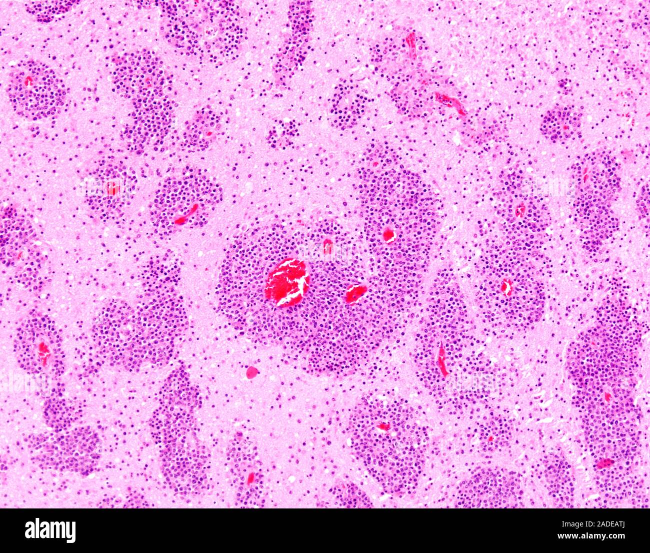 Diffuse large B-cell lymphoma, light micrograph. Diffuse large B-cell ...