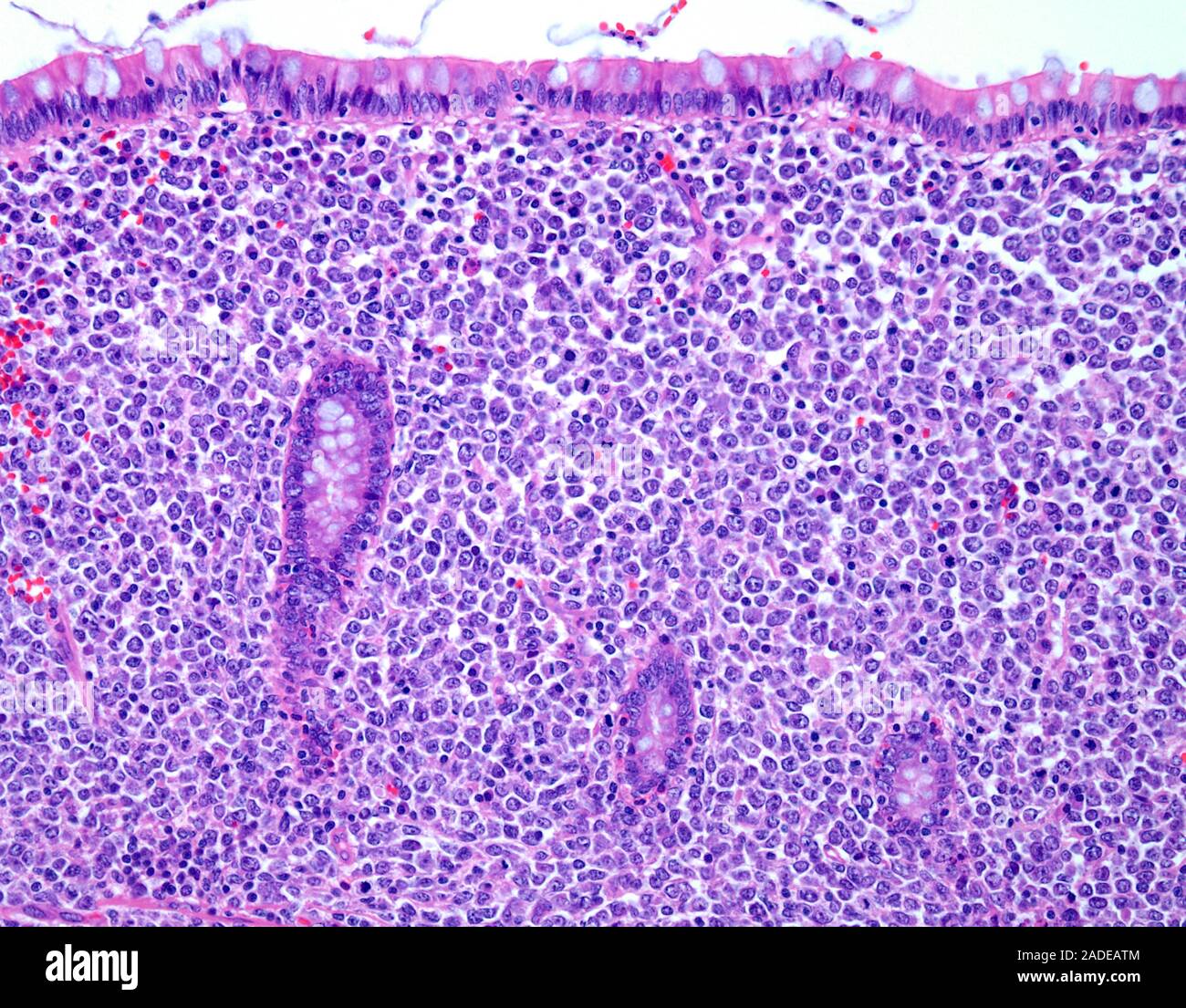 Diffuse large B-cell lymphoma, light micrograph. Diffuse large B-cell lymphoma is the most ...