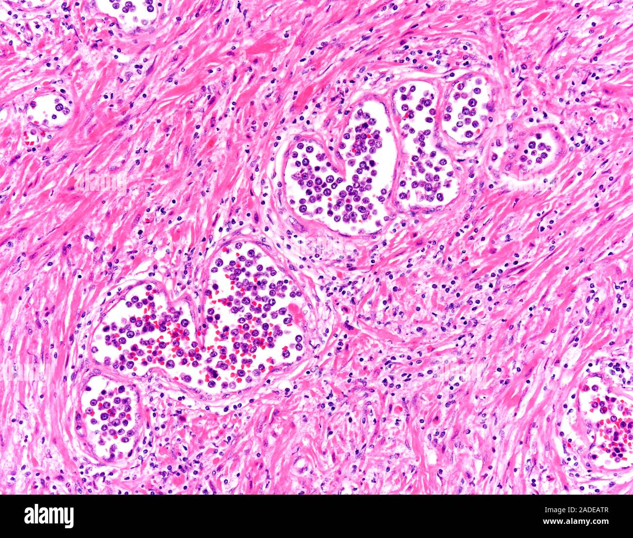 Intravascular large B-cell lymphoma, light micrograph. This is an example of intravascular large ...