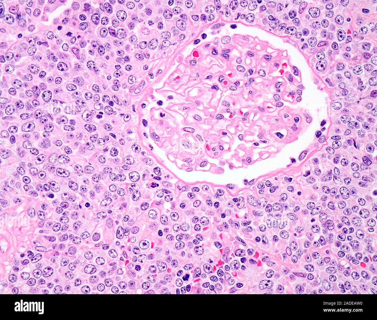 Diffuse large B-cell lymphoma, light micrograph. Diffuse large B-cell lymphoma is the most ...