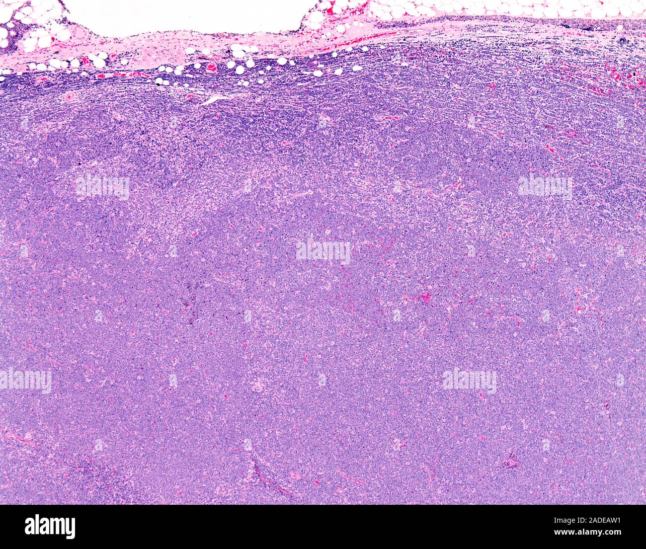 Diffuse large B-cell lymphoma, light micrograph. Diffuse large B-cell lymphoma is the most ...