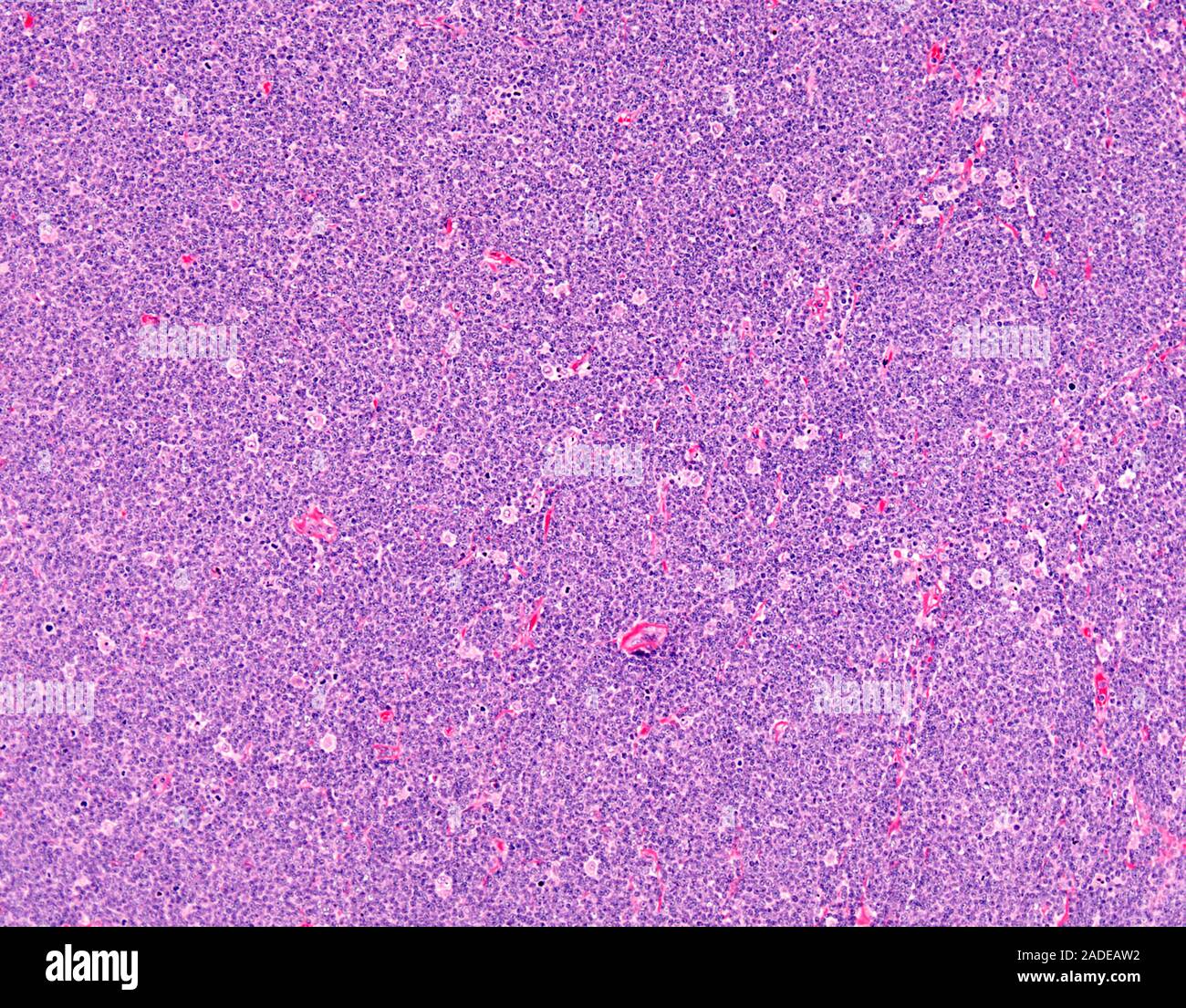 Diffuse large B-cell lymphoma, light micrograph. Diffuse large B-cell lymphoma is the most ...