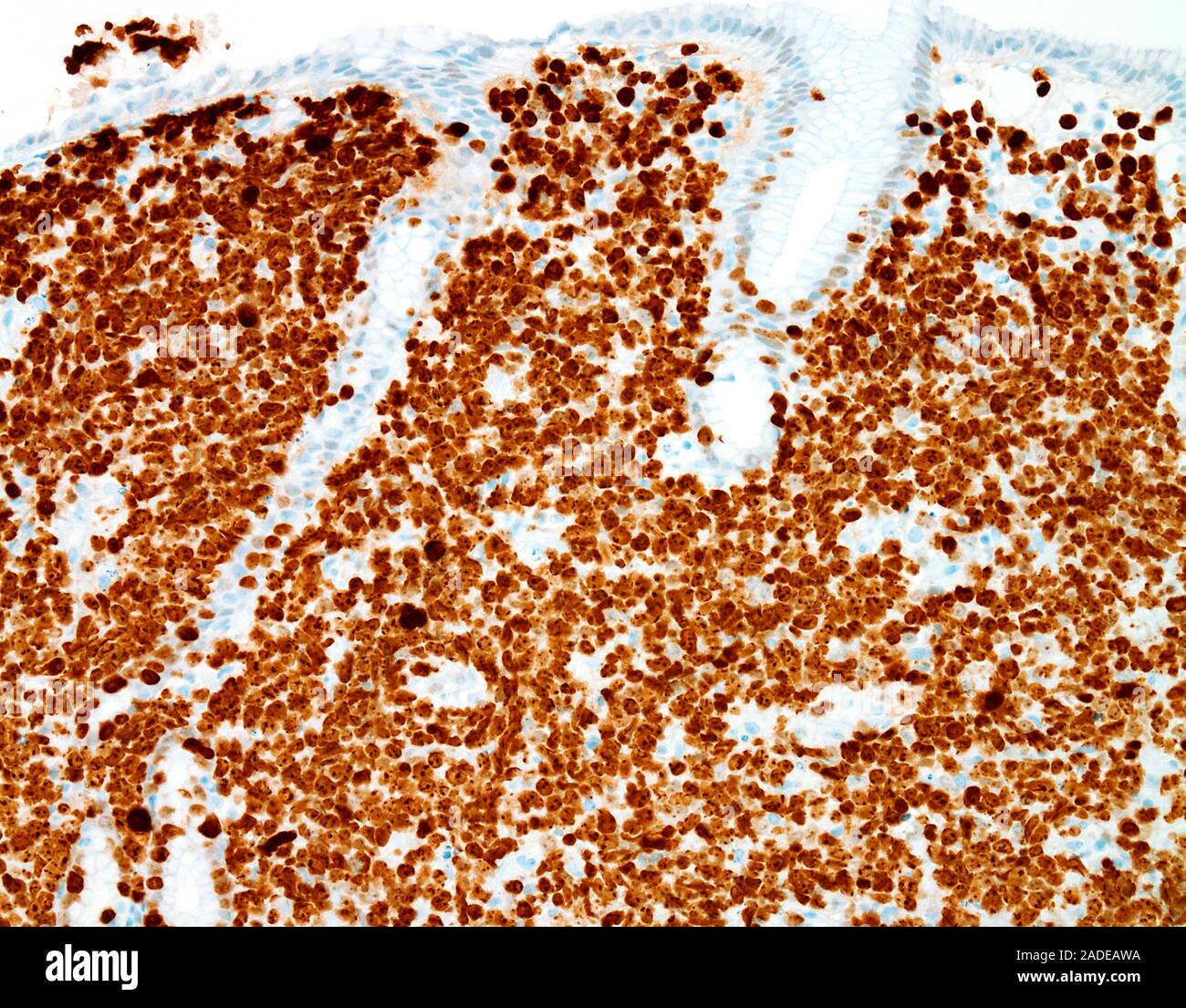 Diffuse large B-cell lymphoma, light micrograph. Diffuse large B-cell ...