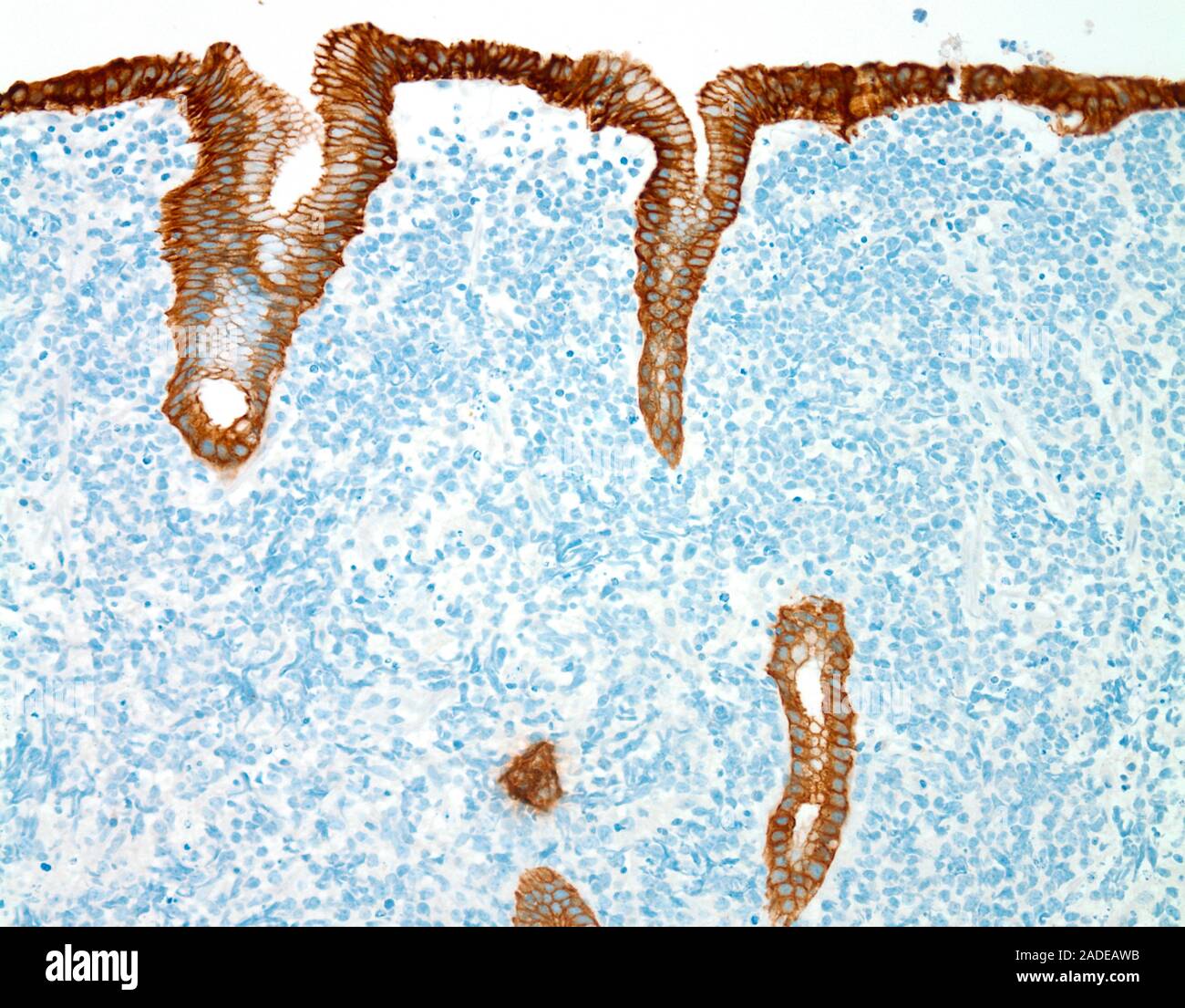 Diffuse large B-cell lymphoma, light micrograph. Diffuse large B-cell ...