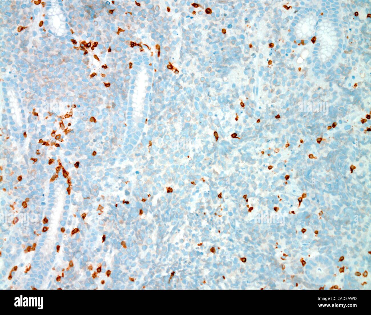 Diffuse large B-cell lymphoma, light micrograph. Diffuse large B-cell ...