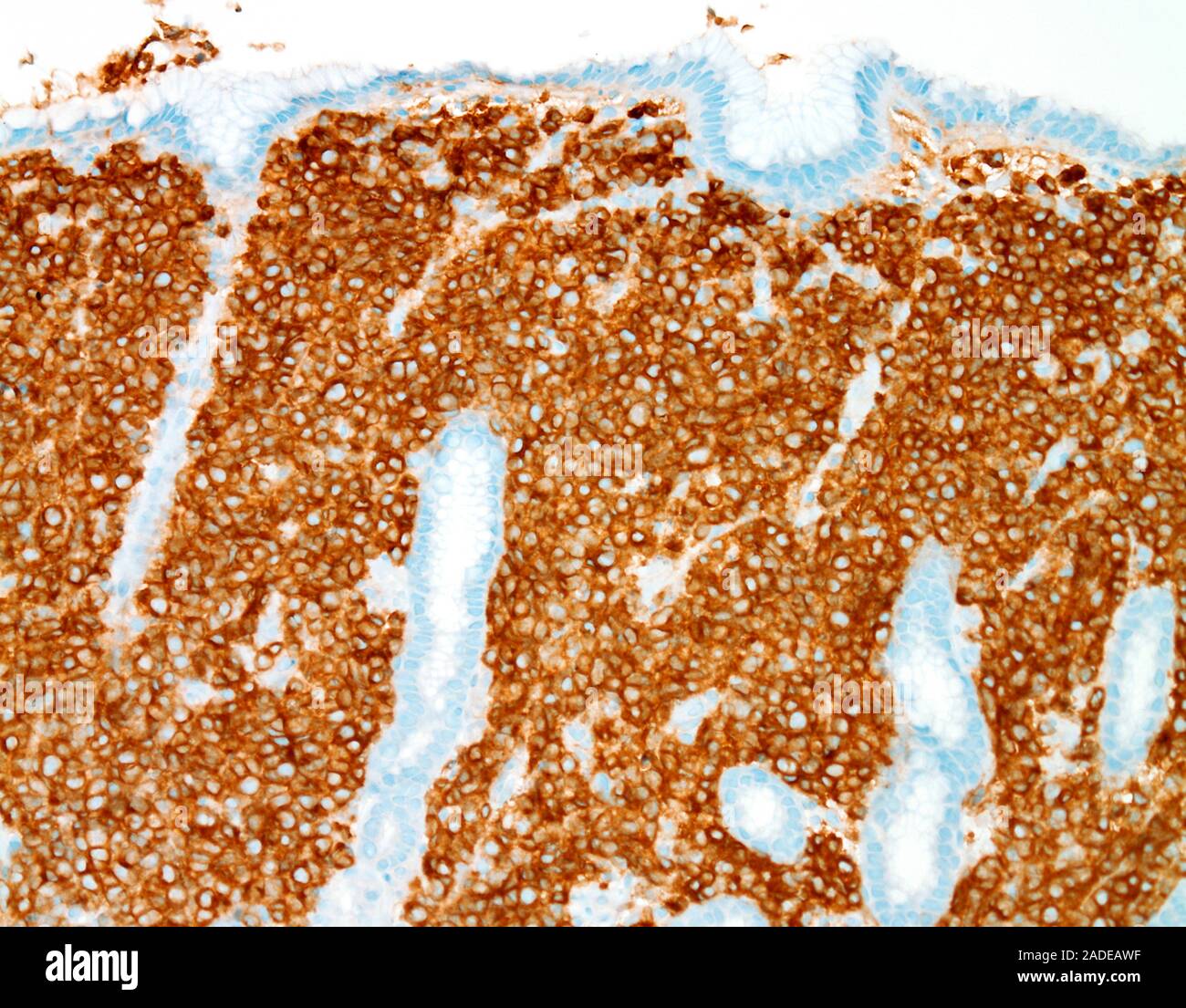 Diffuse large B-cell lymphoma, light micrograph. Diffuse large B-cell ...
