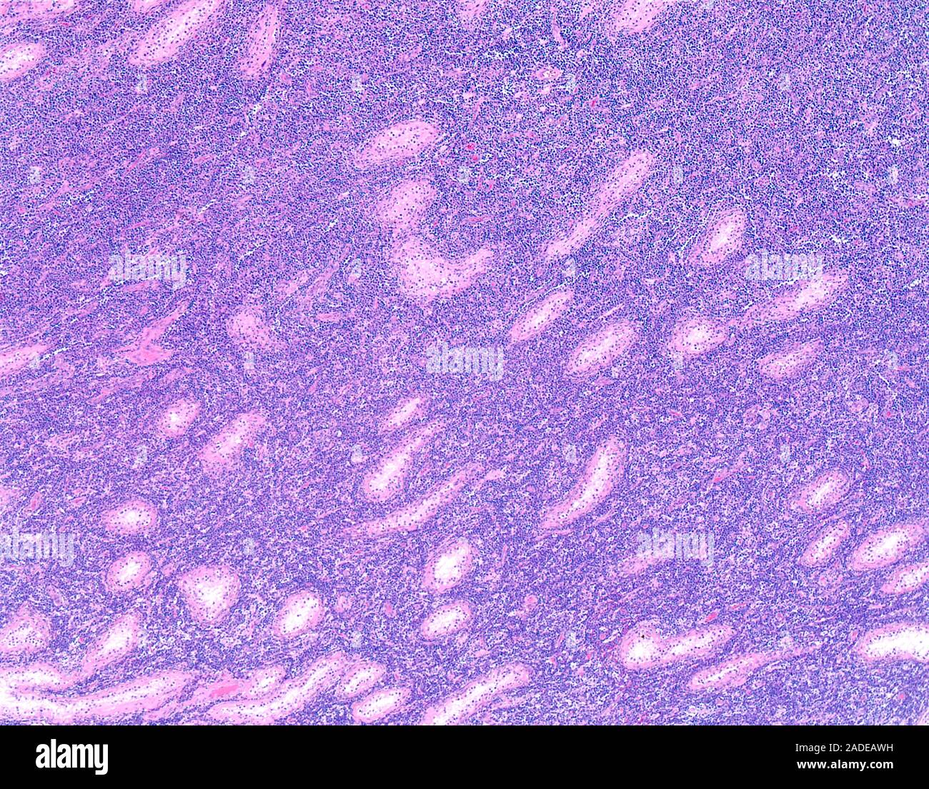 Diffuse large B-cell lymphoma, light micrograph. Diffuse large B-cell lymphoma is the most ...