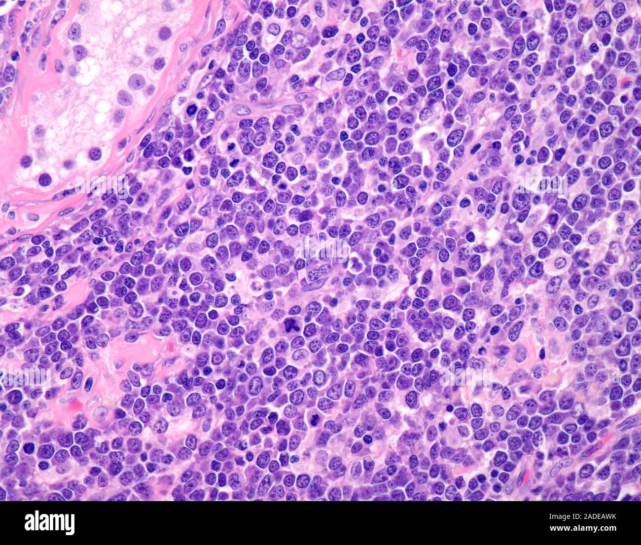 Diffuse large B-cell lymphoma, light micrograph. Diffuse large B-cell lymphoma is the most ...