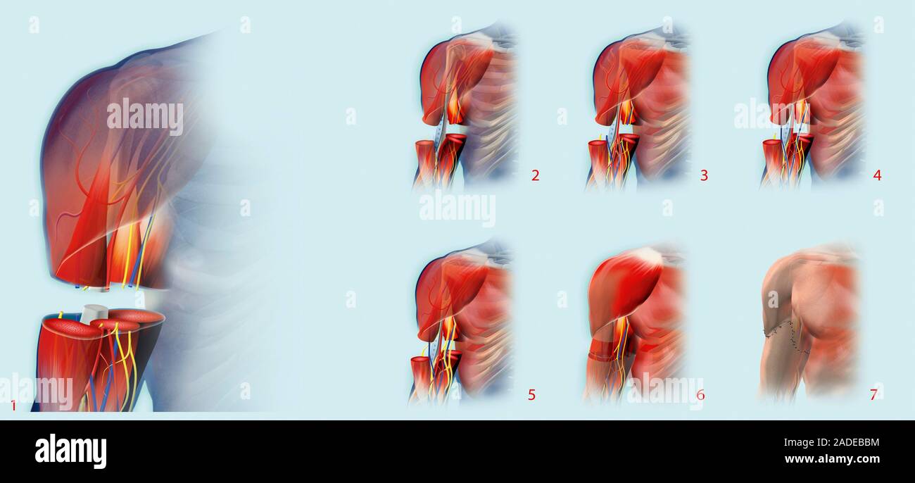 Arm transplant operation, illustration. Sequence of seven images ...