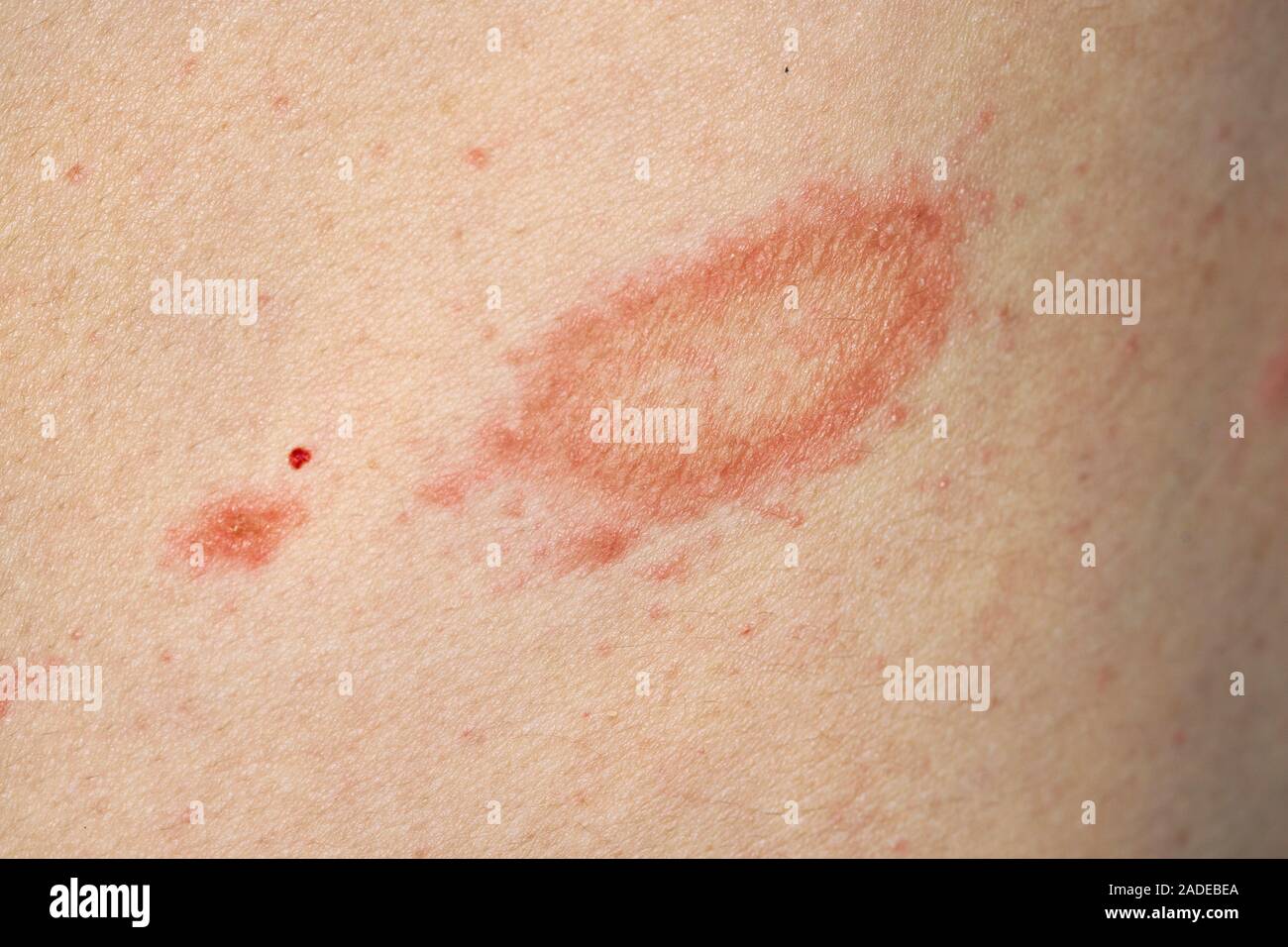 Close-up of a red lesion (known as a herald patch) on the skin of a ...