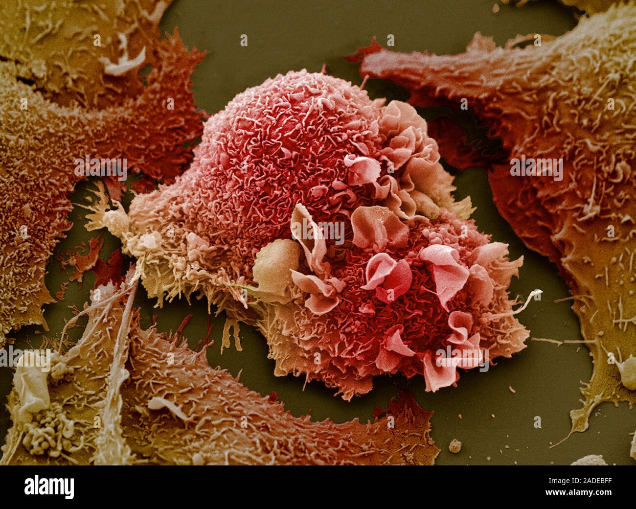 Images not to be used by the tobacco industry. Lung cancer cells ...
