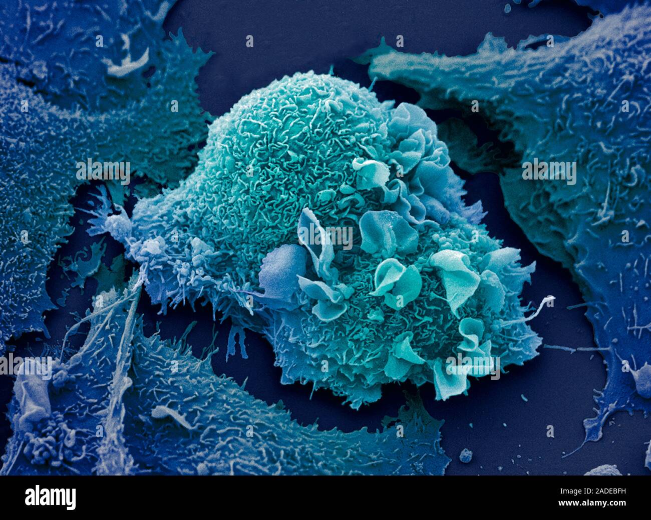 Images not to be used by the tobacco industry. Lung cancer cells ...
