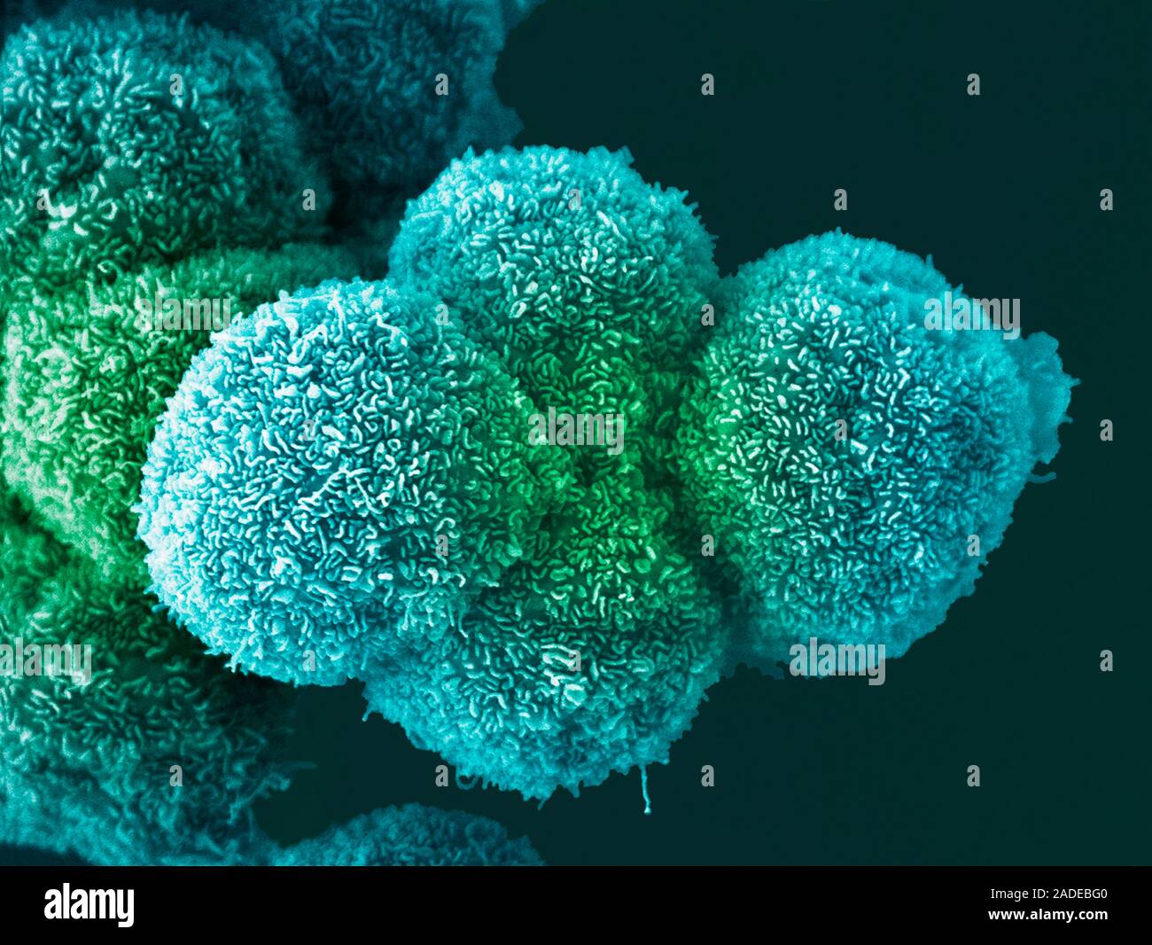 Images not to be used by the tobacco industry. Pancreatic cancer cells ...