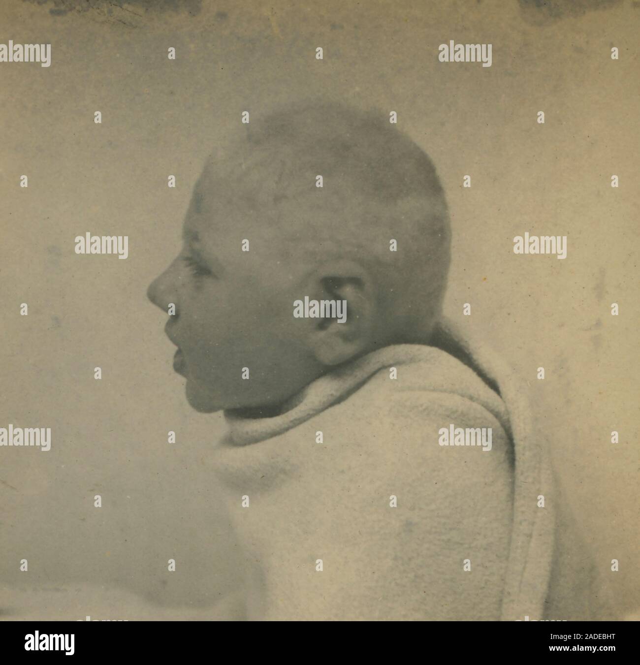 Microcephaly, historical image. Microcephaly is a developmental ...