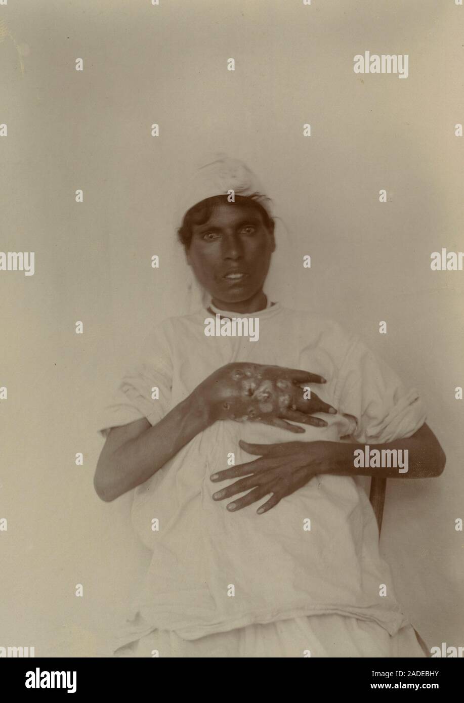 Mycetoma of the hand, historical image. This chronic subcutaneous ...