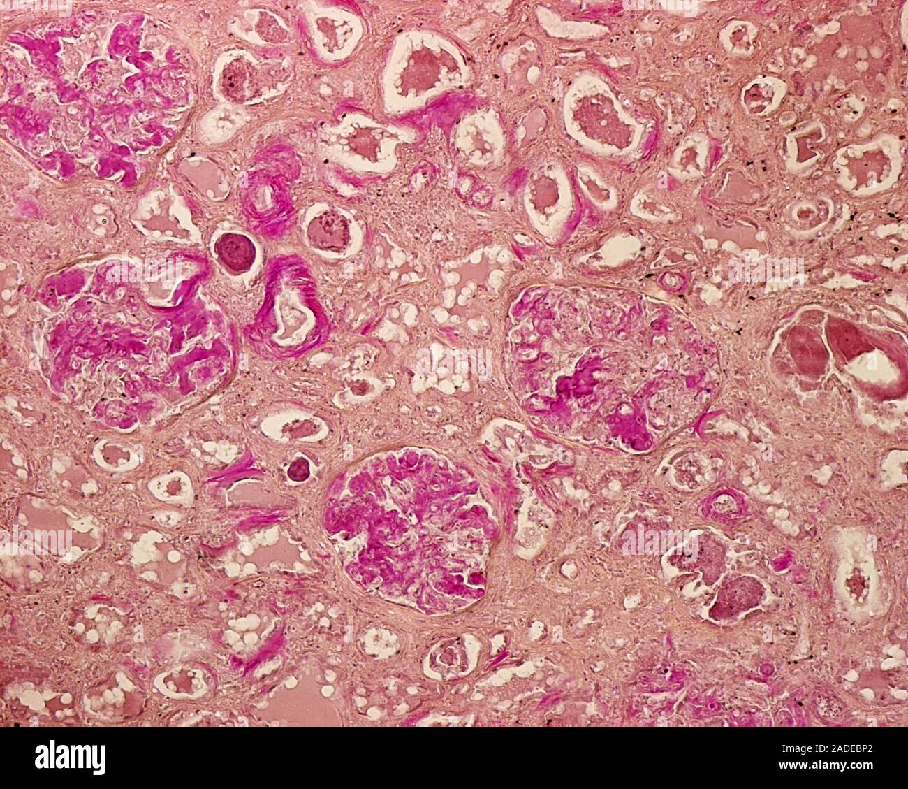 Amyloidosis. Light micrograph of a section through tissue with abnormal ...