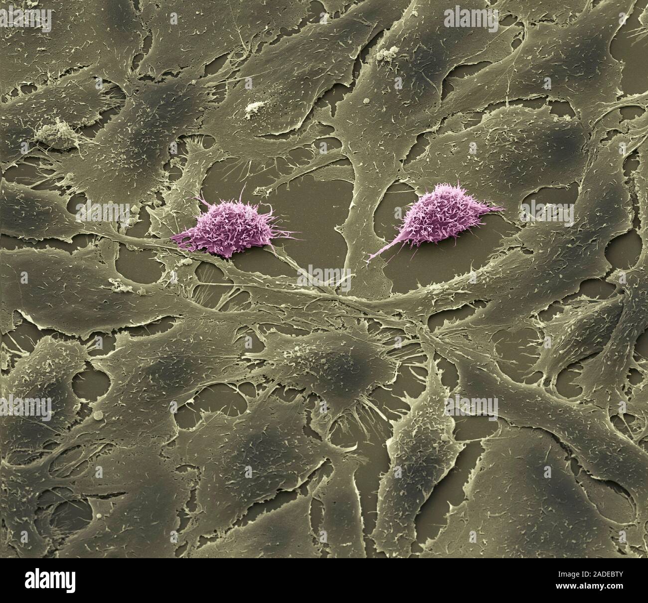 Cancer cell culture, coloured scanning electron micrograph (SEM). The ...