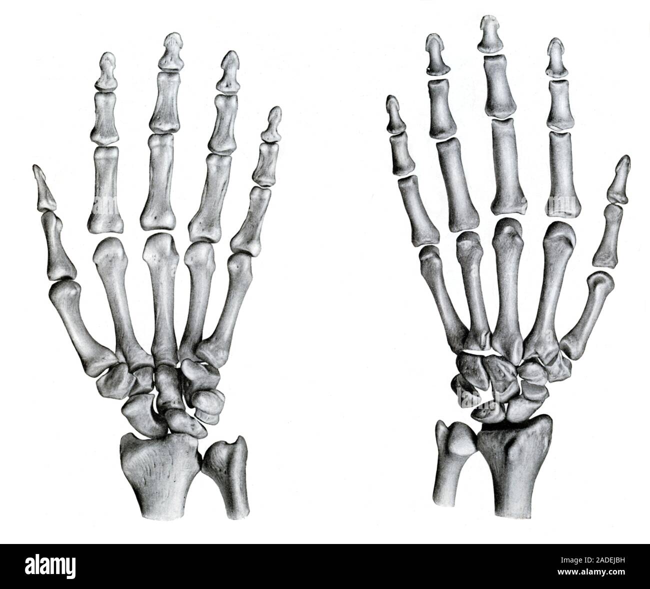Illustrations of the bones of the left hand seen from the dorsal aspect ...