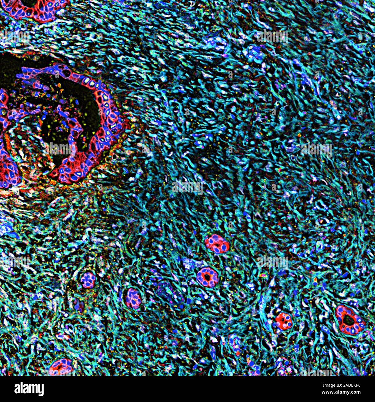 Desmoplasia in pancreatic cancer. Light micrograph of a section through ...