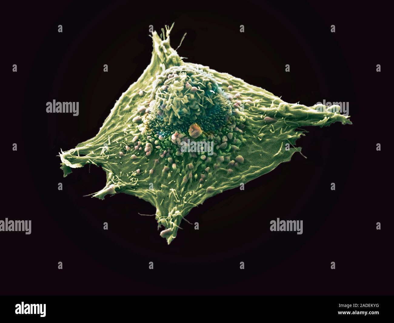Images not to be used by the tobacco industry. Lung cancer cell ...
