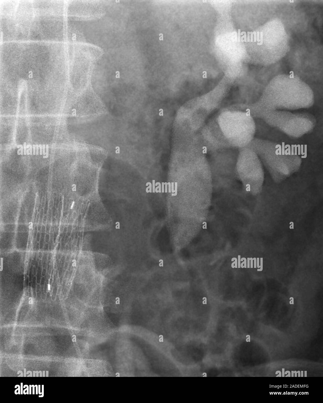 Aortic stent. Angiogram of a section through a patient's abdomen and ...