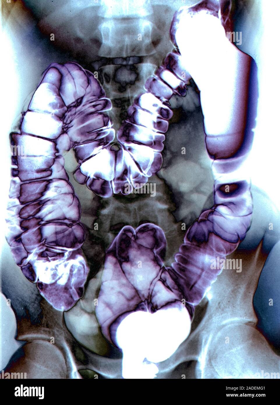 Normal colon. Coloured X-ray of a section through the abdomen of a 55 ...