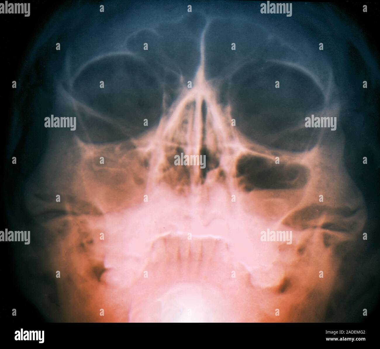 Sinusitis. Coloured X-ray of a frontal section through the face of a 37 ...