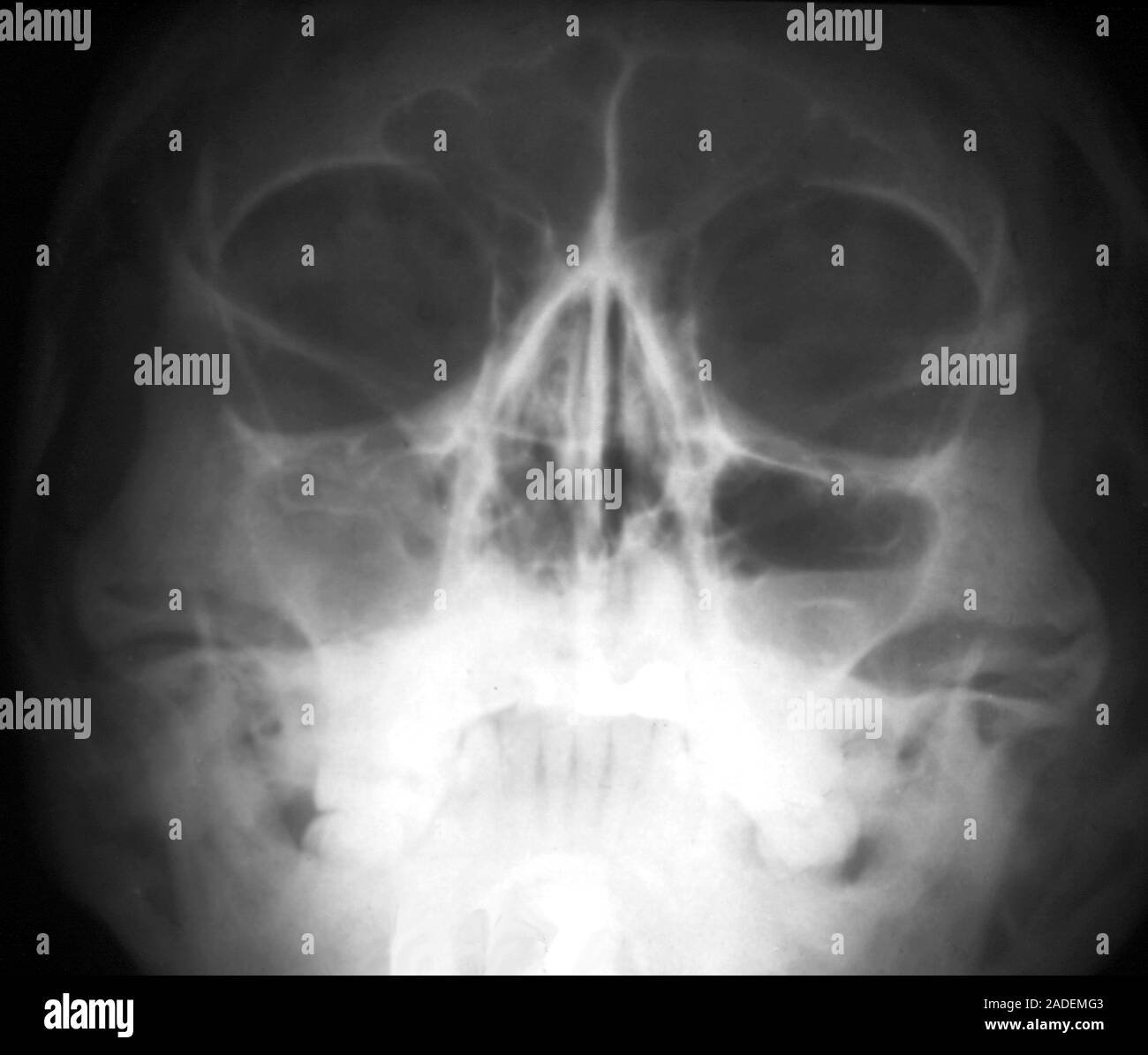 Sinusitis. X-ray of a frontal section through the face of a 37-year-old ...
