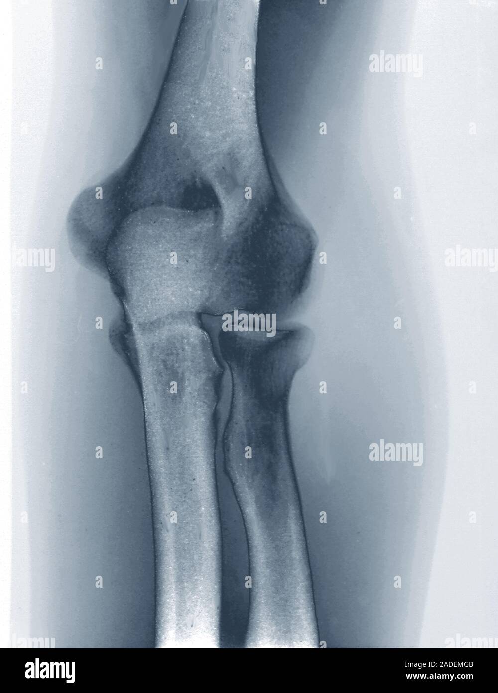 Normal elbow joint. X-ray of a section through the healthy right elbow ...