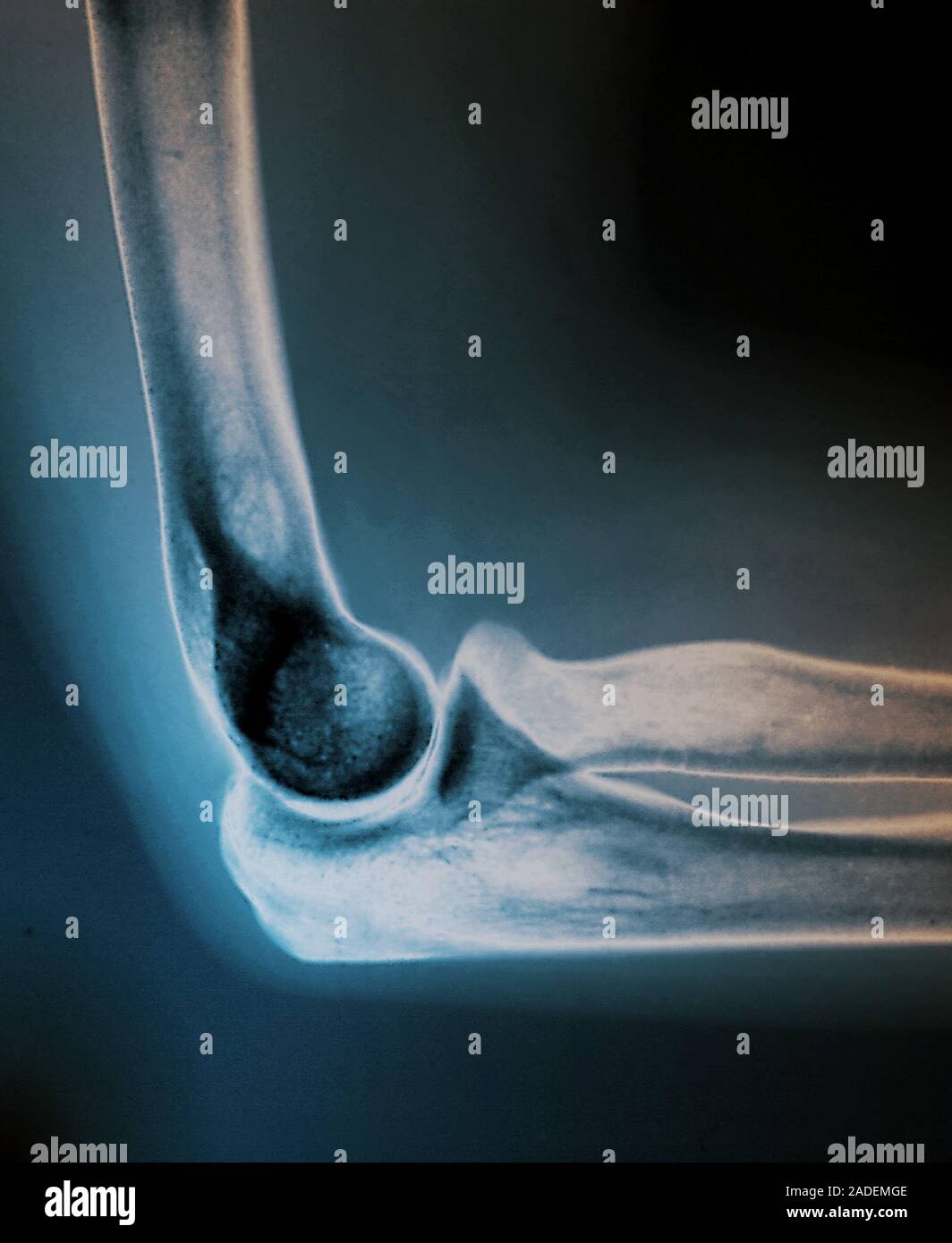 Normal elbow joint. Coloured X-ray of a section through the healthy ...